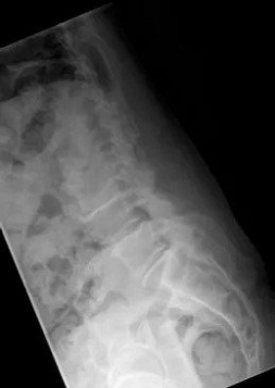 Adult Degenerative Scoliosis